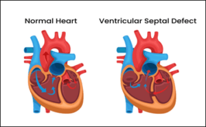 Ventricular Septal Defect (VSD) – Diagnosis & Echocardiography ...