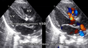 Ventricular Septal Defect (VSD) – Diagnosis & Echocardiography ...