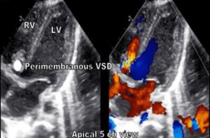 Ventricular Septal Defect (VSD) – Diagnosis & Echocardiography ...