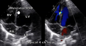Ventricular Septal Defect (VSD) – Diagnosis & Echocardiography ...