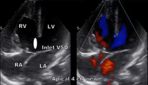 Ventricular Septal Defect (VSD) – Diagnosis & Echocardiography ...