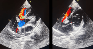 Ventricular Septal Defect (VSD) – Diagnosis & Echocardiography ...