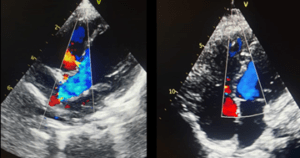 Ventricular Septal Defect (VSD) – Diagnosis & Echocardiography ...