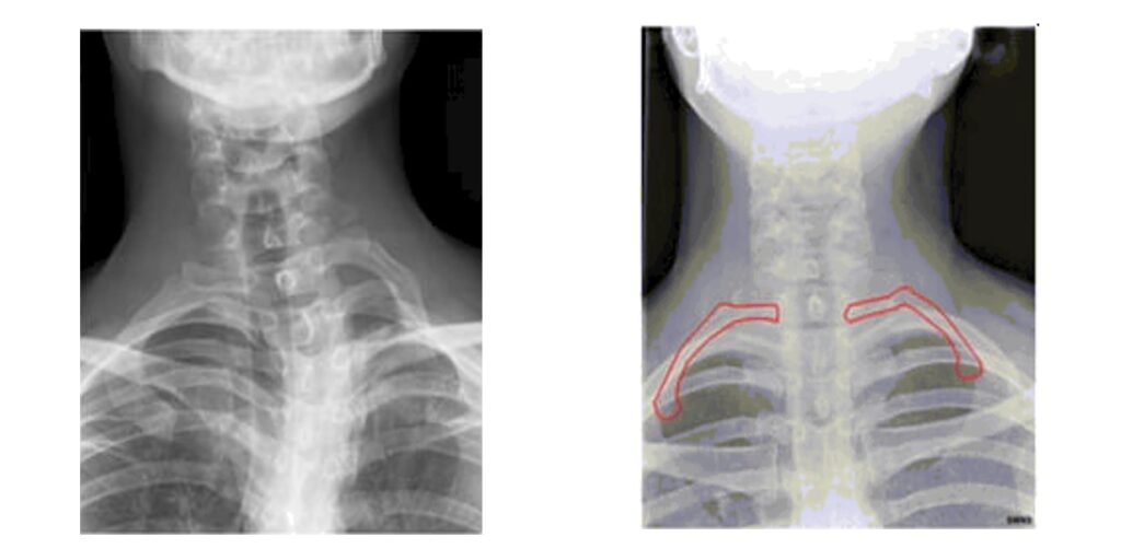 Arterial Thoracic Outlet Syndrome: A case report - Kauvery Hospital