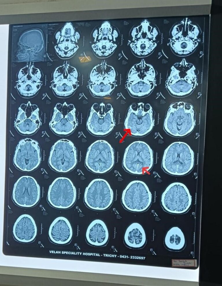 Cerebral Venous Thrombosis (CVT): A case report - Kauvery Hospital