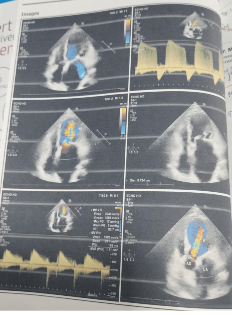 Balloon Mitral Valvotomy - Kauvery Hospital