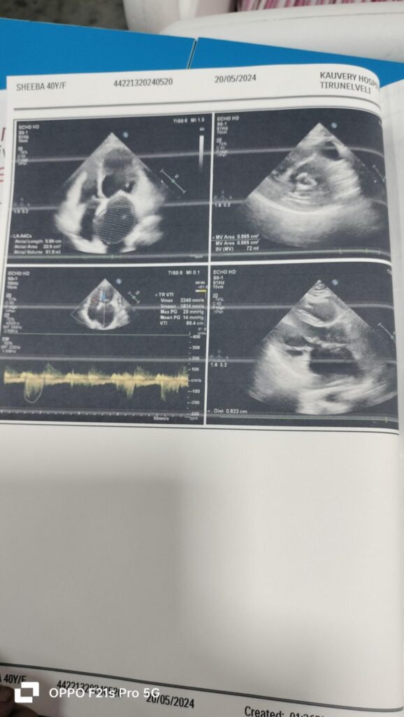 Balloon Mitral Valvotomy - Kauvery Hospital