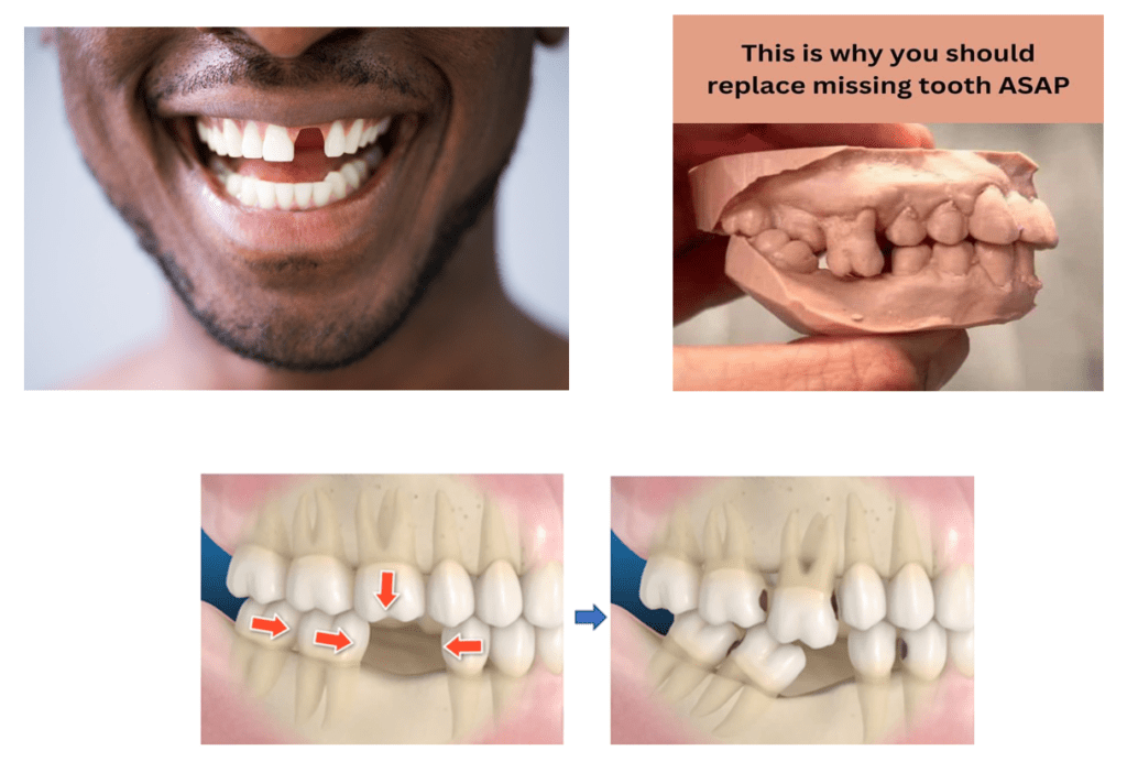 Dental implants: Our experience and expertise - Kauvery Hospital