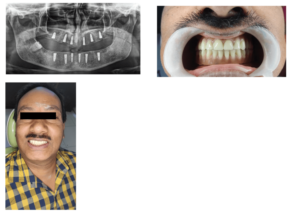 Dental implants: Our experience and expertise - Kauvery Hospital