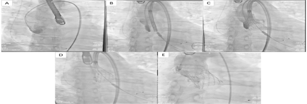 Trans catheter Aortic Valve Implantation (TAVI) - Kauvery Hospital