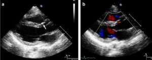 Tetralogy of Fallot (TOF): Echocardiography - Kauvery Hospital