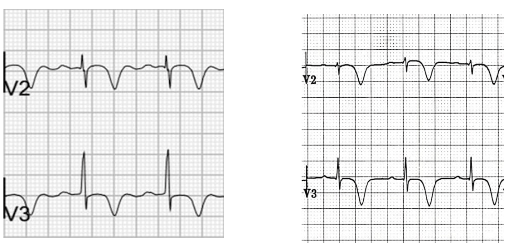 Wellen’s Syndrome - Kauvery Hospital