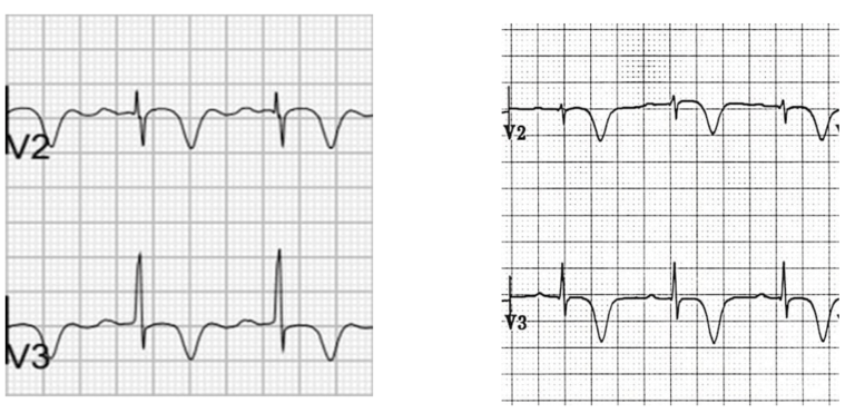 Wellen’s Syndrome - Kauvery Hospital