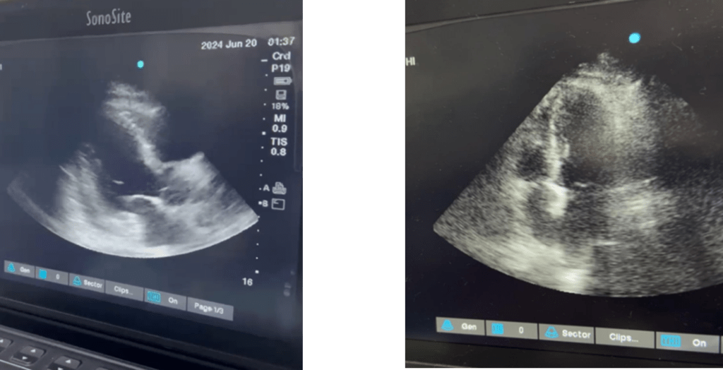 Critical Management of Acute Cardiac Tamponade in a CKD Patient: A Case ...