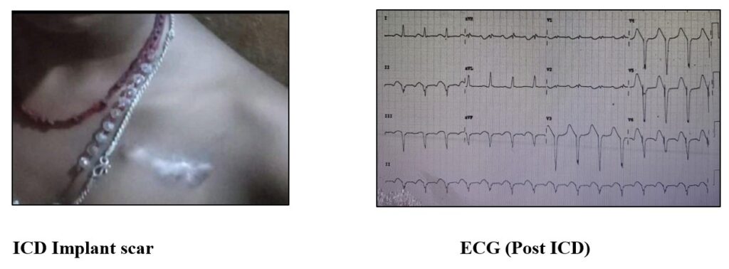 ICD Implant in a 6-Year-Old with Jervell and Lange-Nielsen Syndrome: A ...
