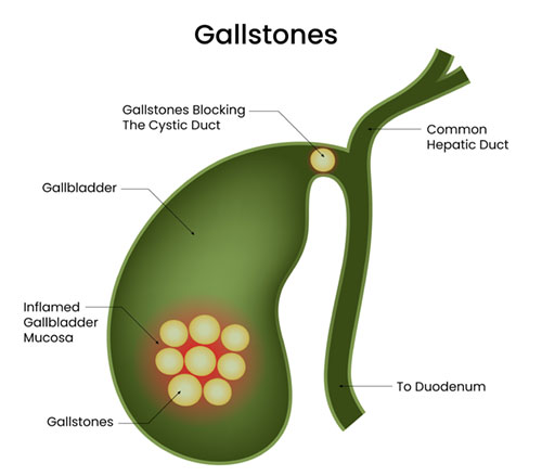 Cholelithiasis or Gall Stone Disease | Causes, Symptoms, Diagnosis ...