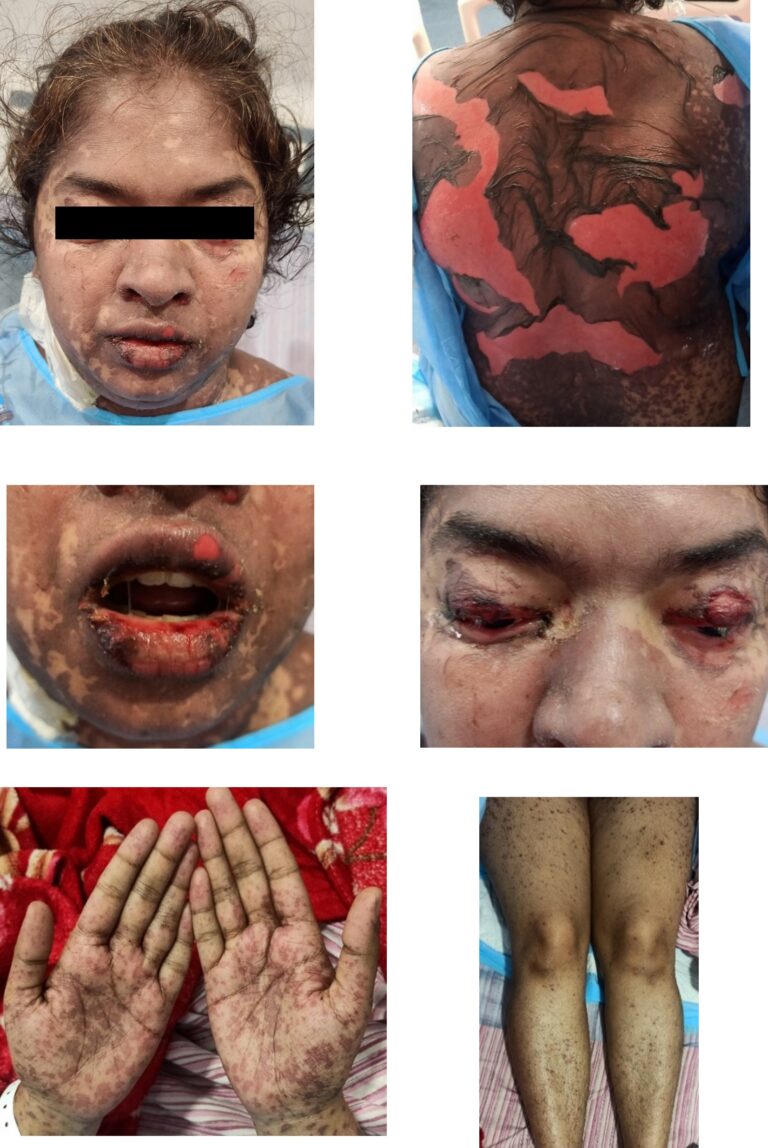 Dermatologic Emergencies Case Series: Successful Management of TEN, and ...