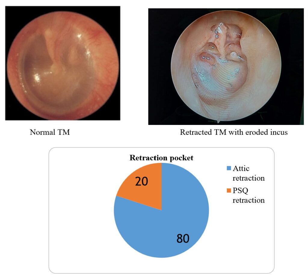 Audit on Pediatric Cholesteatoma – Clinical Study by S. Lakshmipriya ...