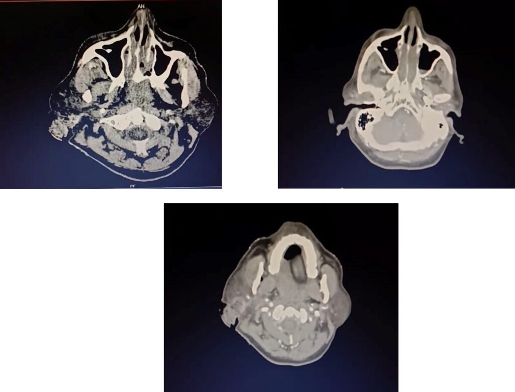Open stab injury by a Bull - Kauvery Hospital