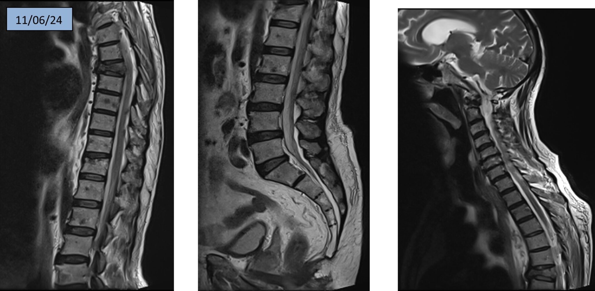 Case Report on Multiple Myeloma: Role of MRI in Pre- and Post-Treatment ...