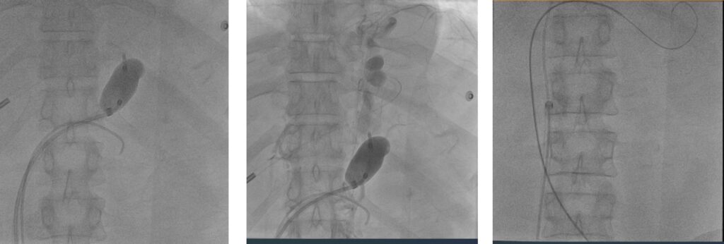 BRTO: A Life-Saving Solution for Gastric Variceal Bleeding | Kauvery ...