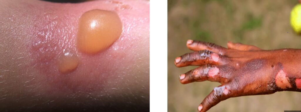 Multidisciplinary Approach to Thermal Burns at Kauvery Hospital