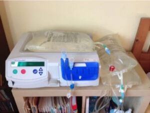 CAPD – Continuous Ambulatory Peritoneal Dialysis | Advantages of CAPD ...