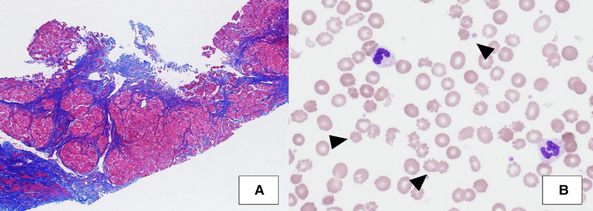 Journal Scan: Recent Clinical Research on Oxalate Nephropathy, Spur ...