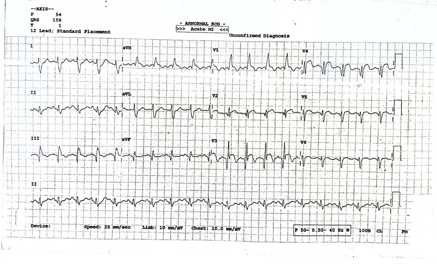 MPI scan guided revascularization in acute anterior wall Myocardial ...
