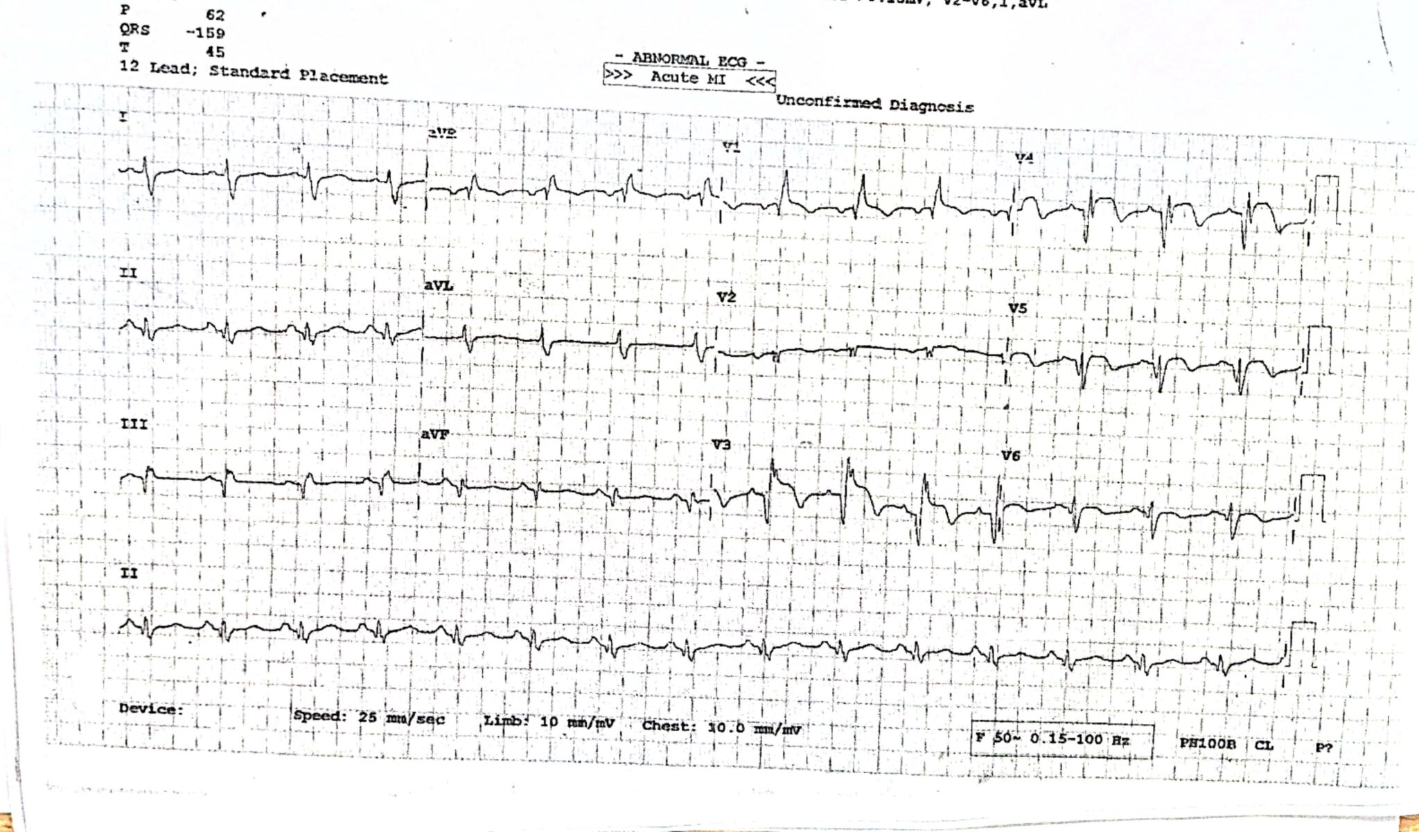 MPI scan guided revascularization in acute anterior wall Myocardial ...