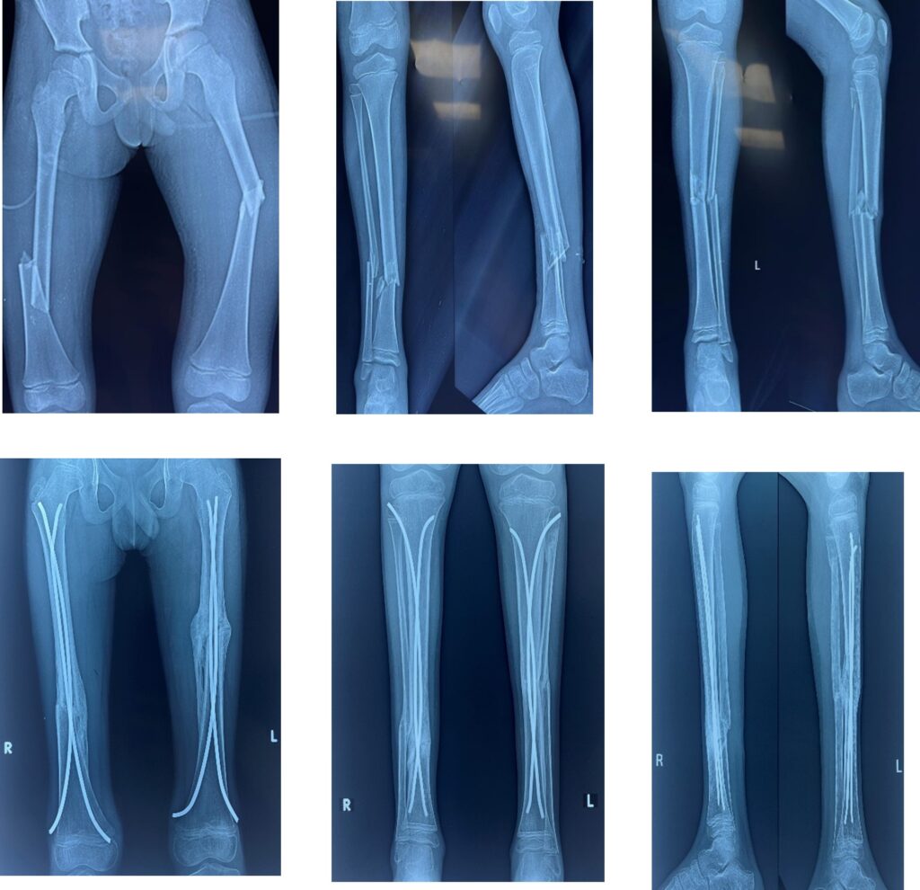 Traumatic Simultaneous Bilateral Femur and Tibia Fractures in an 8-Year ...