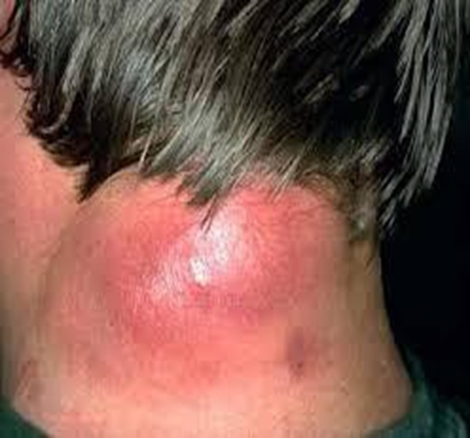 Comprehensive Case Report on Carbuncle Management | Kauvery Hospital