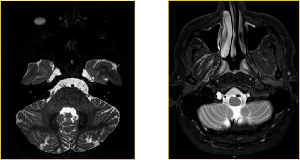 Chronic IIH Variants: Imaging Insights from the C-IIH Study