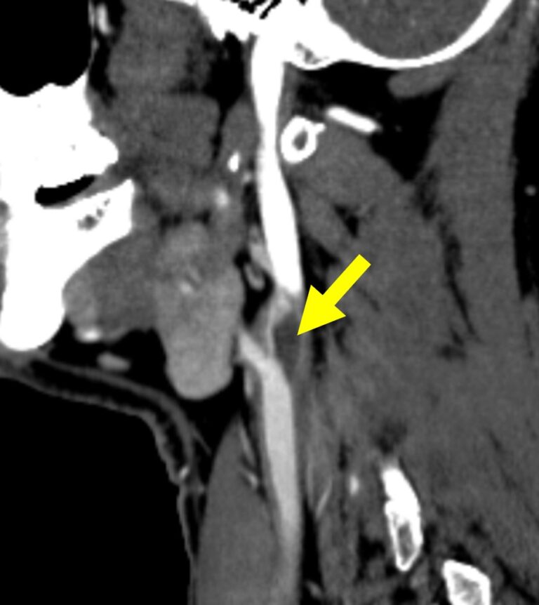 Diagnostic Images: Total occlusion of left cervical ICA - Kauvery Hospital