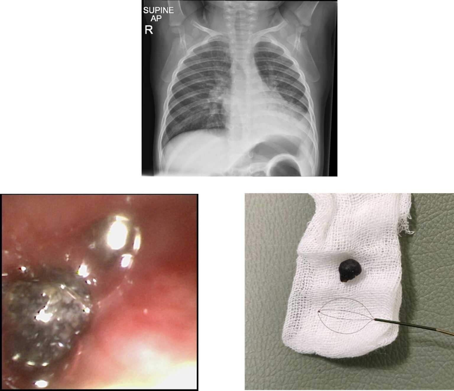 Recurrent or persistent pneumonia: A case series with discussion ...