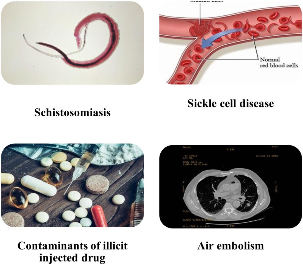 Acute Pulmonary Embolism, highlights of a Kauvery Post Graduate Lecture ...