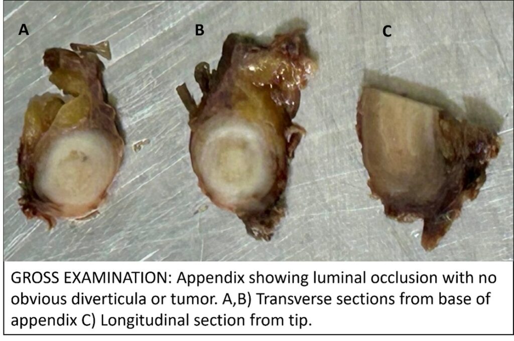 Appendiceal mucosal schwann cell proliferation – rare incidental ...