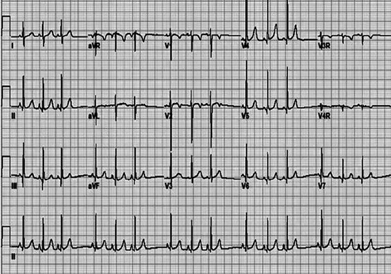 The science behind arrhythmias: Pathophysiology and causes - Kauvery ...