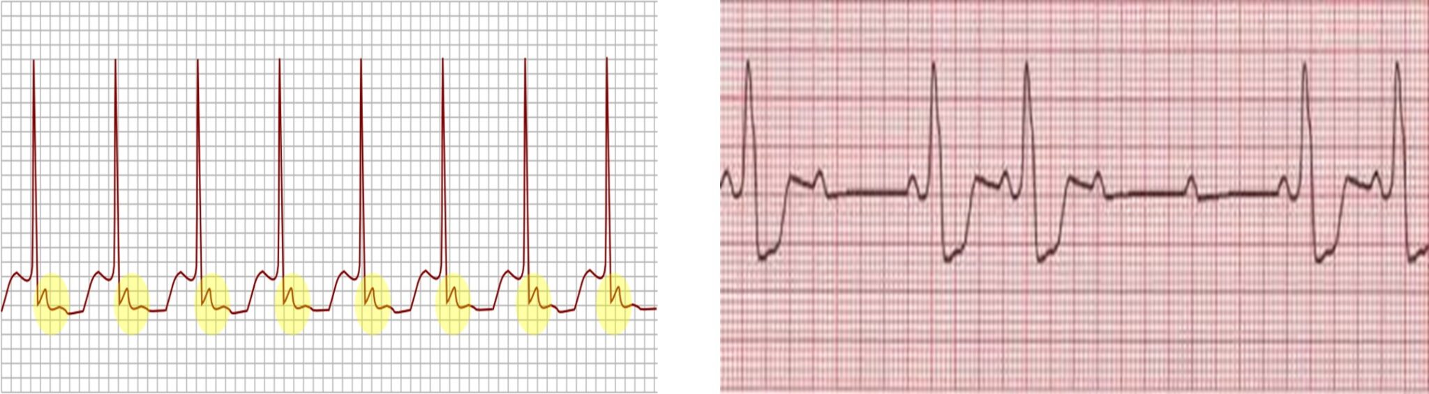 Arrhythmia Pathophysiology & Causes: Science Behind Heart Rhythm ...