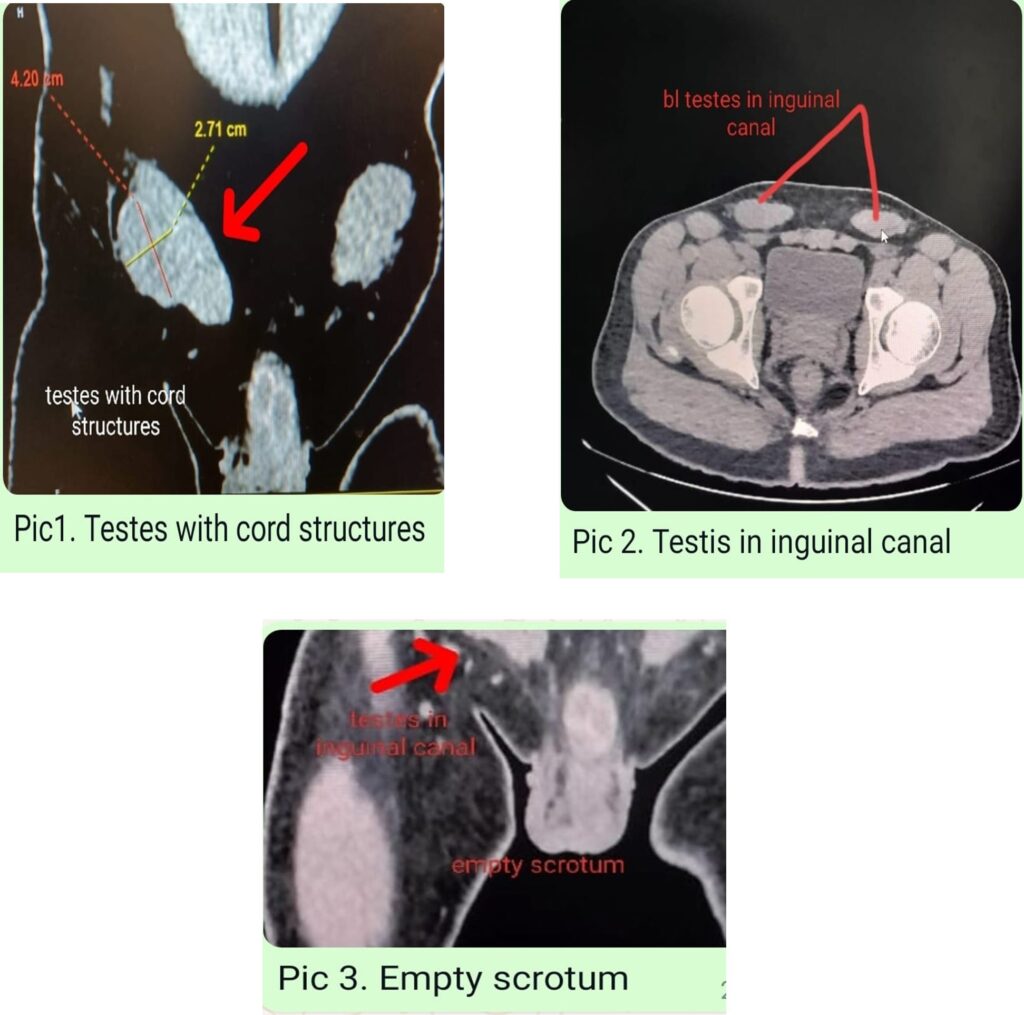 A rare and potentially overlooked case of bilateral testicular ...