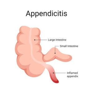 Acute Appendicitis | Causes, Diagnosis, Treatment & Advanced Surgical ...