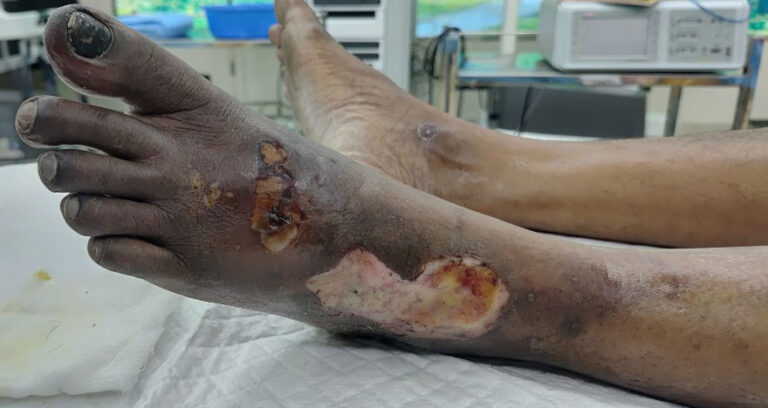 Acute Limb Ischemia | Case Profile & Clinical Progression | Surgical ...
