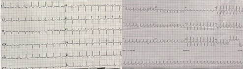 EPS RFA for SVT due to redo-accessory pathways using advanced open ...
