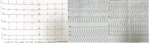 EPS RFA for SVT due to redo-accessory pathways using advanced open ...