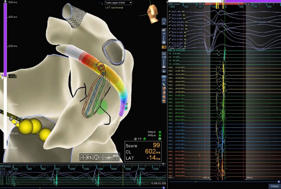 EPS RFA for SVT due to redo-accessory pathways using advanced open ...