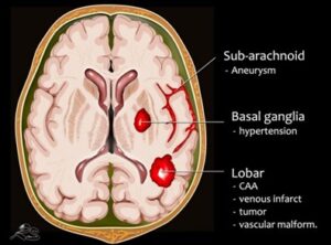 Left Gangliocapsular Hemorrhage & Cranioplasty - Case Study | Kauvery ...