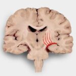 Left Gangliocapsular Hemorrhage & Cranioplasty - Case Study | Kauvery ...