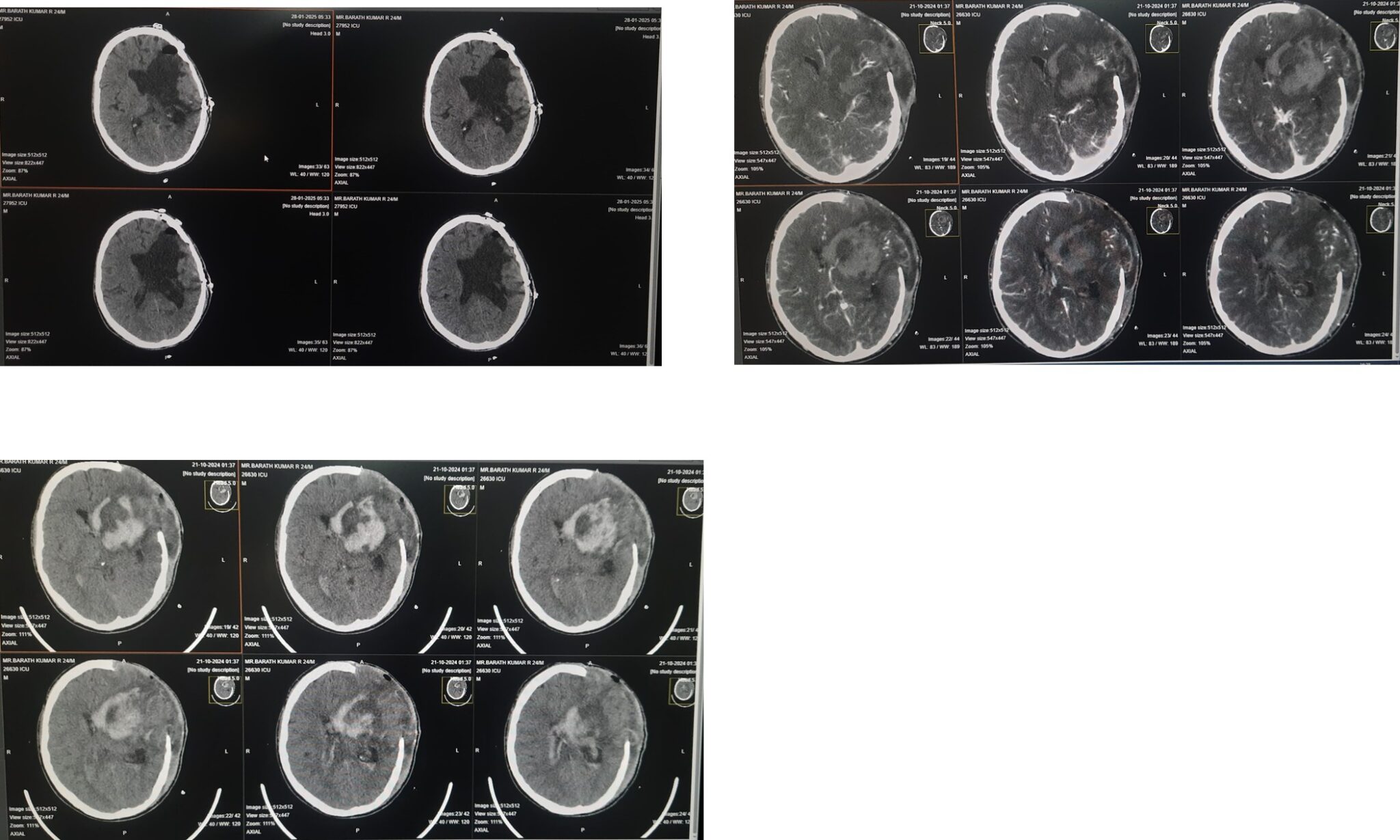 Left Gangliocapsular Hemorrhage & Cranioplasty - Case Study | Kauvery ...