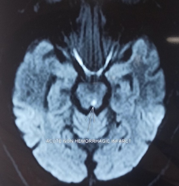 Localizing value of internuclear ophthalmoplegia - Kauvery Hospital