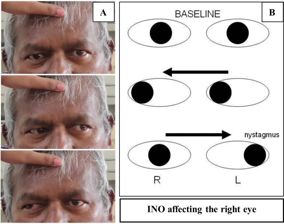 Localizing value of internuclear ophthalmoplegia - Kauvery Hospital